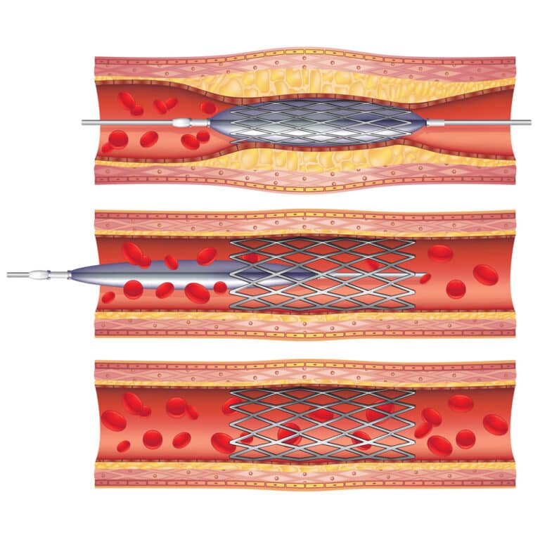 What Is a Stent and How Does It Treat Heart Disease?