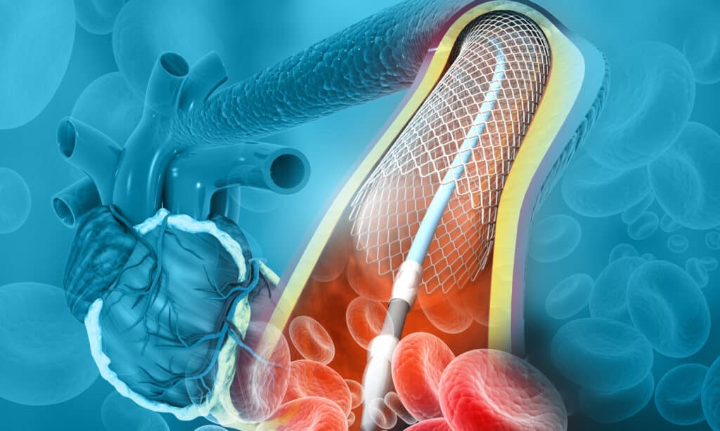 What Is Percutaneous Coronary Intervention?